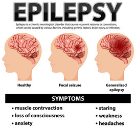 Informative poster of epilepsy Royalty Free Vector Image
