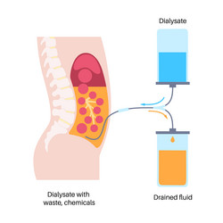 Hemodialysis or kidney dialysis procedure cartoon Vector Image