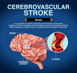 Informative poster of common types of stoke Vector Image