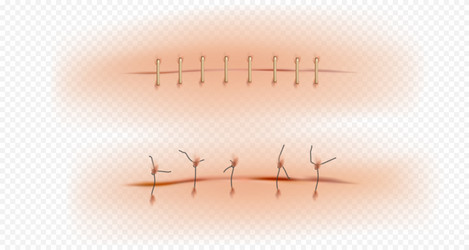 Realistic scars medical surgical sutures wounds Vector Image