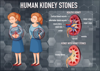 Comparison healthy kidney Royalty Free Vector Image