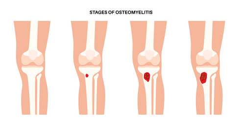 Tibia bone osteomyelitis Royalty Free Vector Image