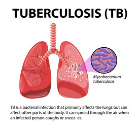 Mycobacterium Tuberculosis Labelled Diagram