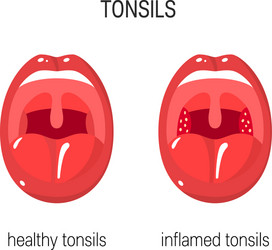 Tonsillectomy scheme removal of palatine tonsils Vector Image