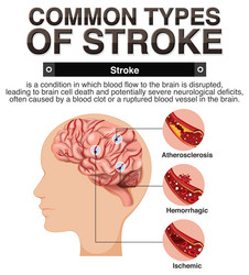 Informative poster of common types stoke Vector Image