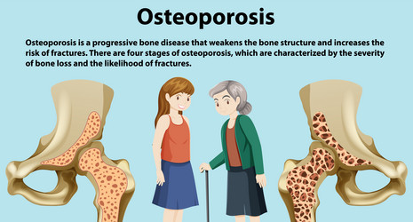 Bone density and osteoporosis Royalty Free Vector Image