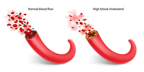 Hdl and ldl cholesterol types good bad Royalty Free Vector