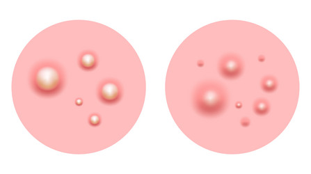 Acne skin pimple Royalty Free Vector Image - VectorStock