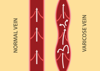 Comparison between normal and unhealthy Royalty Free Vector