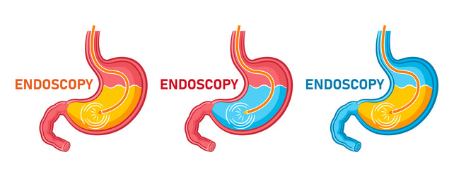 Endoscopy stomach endoscope gastroscopy procedure Vector Image