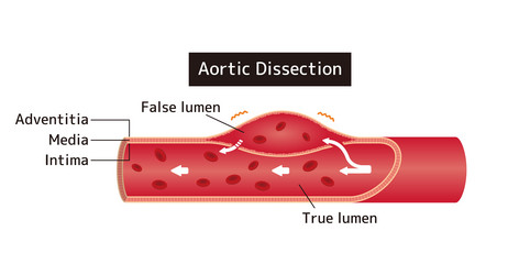 Aortic Dissection Vector Images (29)