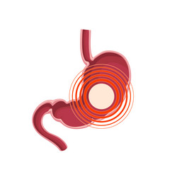 Stomach peptic ulcer charts Royalty Free Vector Image