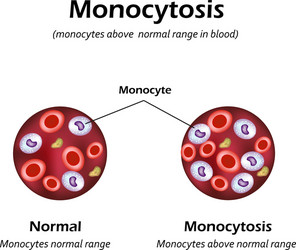 Monocytes above the normal range in blood Vector Image