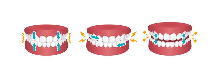 Bruxism tapping teeth Royalty Free Vector Image