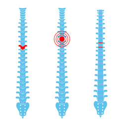 Spine Back Pain Diagram Vector Images (over 160)