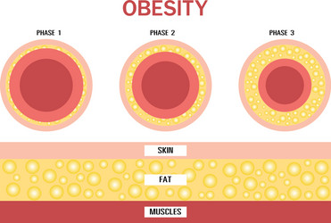 Obesity and overweight layers of skin design Vector Image