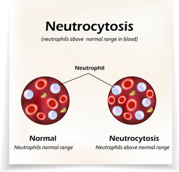Basophils above the normal range in blood Vector Image