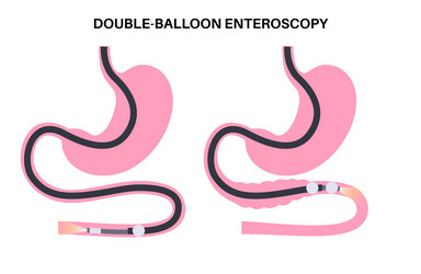 Double balloon enteroscopy Royalty Free Vector Image