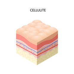 Acne vulgaris or pimple cross-section human Vector Image
