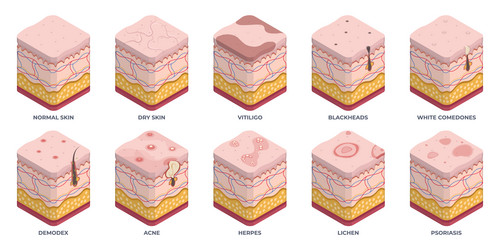 Subcutaneous Acne Vector Images (41)