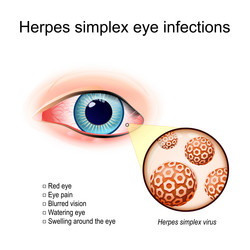 Herpes simplex virus with explanation Royalty Free Vector