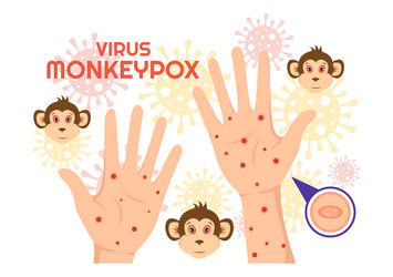 Monkey pox outbreak of virus symptoms in humans Vector Image