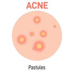 Acne types set Royalty Free Vector Image - VectorStock