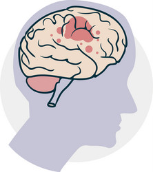 Alzheimers disease brain and neurons Royalty Free Vector