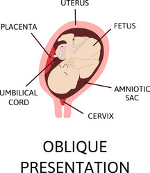 Fetal Presentation Vector Images (38)