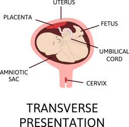 Fetal Presentation Vector Images (38)