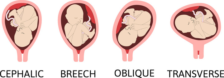 Fetal Presentation Vector Images (38)