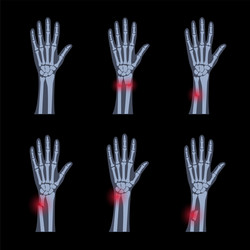 Open Fracture Vector Images (over 510)