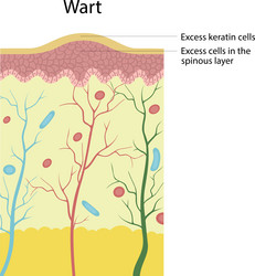 Warts Wart Skin Vector Images (over 250)