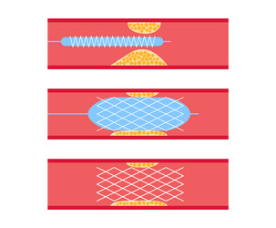 Angioplasty cardiac stent Royalty Free Vector Image