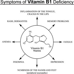 Symptoms vitamin b1 deficiency infographics Vector Image