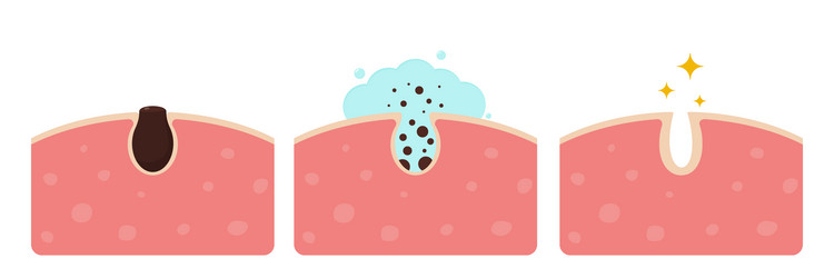Cleaning clogged pores skin Royalty Free Vector Image