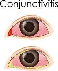 Conjunctivitis Vector Images (over 3,400)