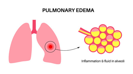 Pulmonary Edema Diagram