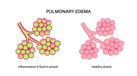 Pulmonary edema disease Royalty Free Vector Image