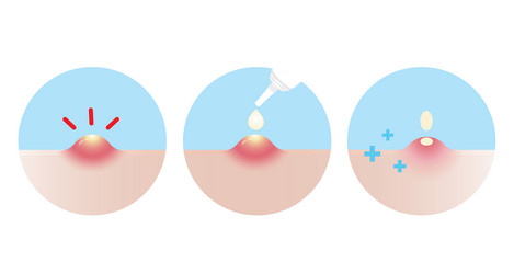 Acne pimple treatment for papule icon set Vector Image