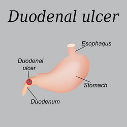 Duodenum ulcer affected duodenal ulcer Royalty Free Vector