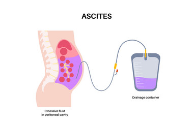 Paracentesis Vector Images (33)