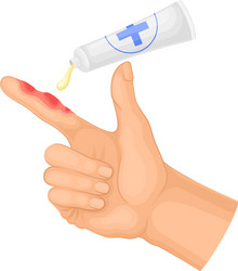 First aid for hand with ambustion or burn Vector Image