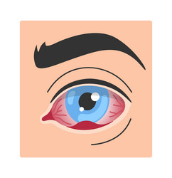 Stye human eye disease Royalty Free Vector Image