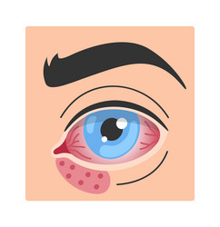 Herpes simplex infection eye disease Royalty Free Vector
