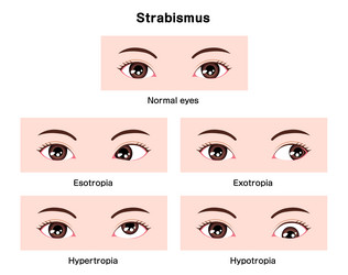 Types of strabismus Royalty Free Vector Image - VectorStock