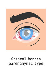 Corneal herpes parenchymal eye disease Royalty Free Vector