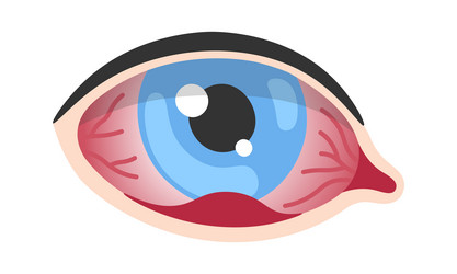 Stye human eye disease Royalty Free Vector Image