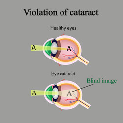 Structure of the eye eye cataracts affected Vector Image