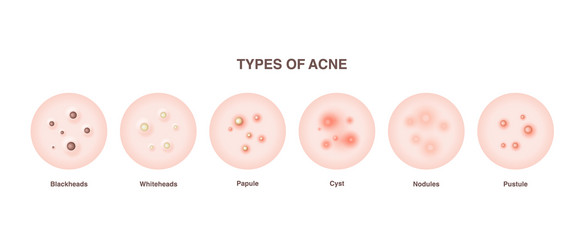 Acne types set Royalty Free Vector Image - VectorStock